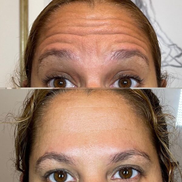 Botox - 3 - Hudson Valley Beauty Lab & Medi Spa